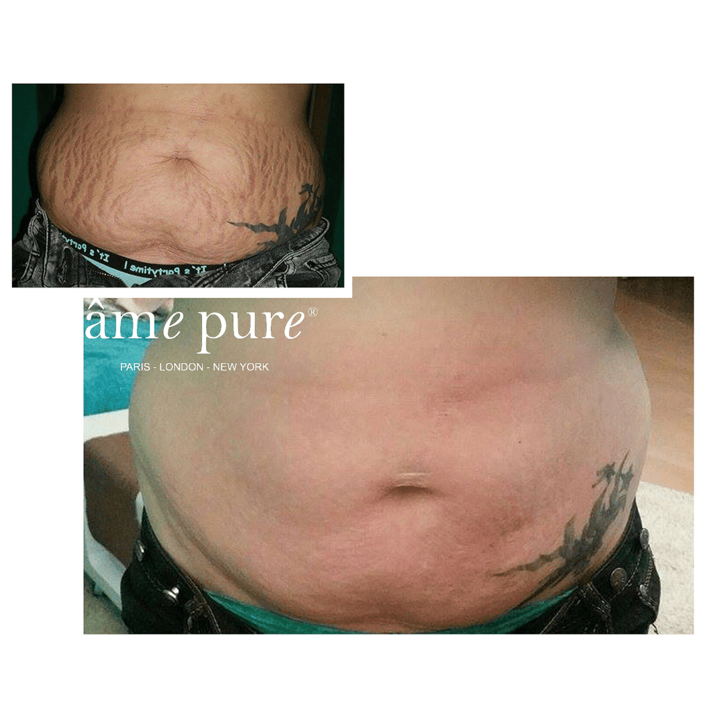 Intensive Stretch Marks Eraser | âme pure – AmePure.eu